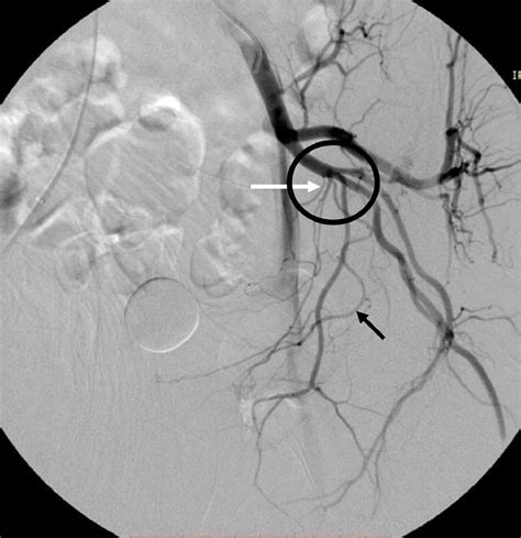 Prostatic Artery Embolization Variant Origins And Collaterals