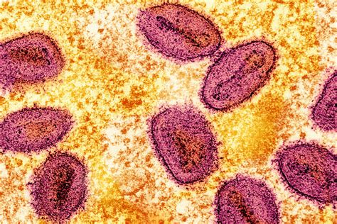Who Launches Global Mpox Strategy Including Strategic Vaccinations