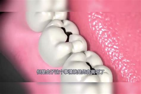 蛀牙真是被虫子吃空的吗3D动画模拟生长过程网友看着都疼 模拟 动画 虫子