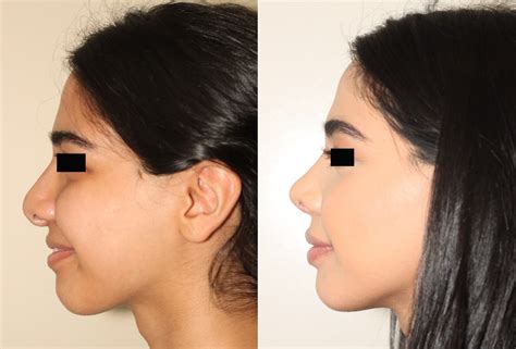 127 Rhinoplasty Dr Denton