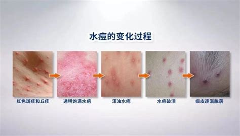 水痘感染血小板降至11 血小板低病友交流