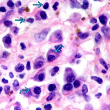 Cutaneous Plasmacytoma Basicmedical Key