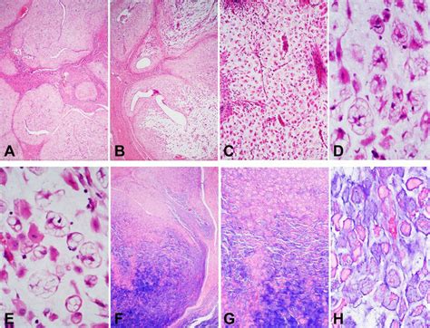 Case 3 Endometriosis In A Cesarean Section Scar Stromal Download Scientific Diagram