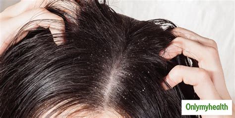 Do You Have Acne On Scalp Know The Main Causes Of Scalp Acne Breakouts OnlyMyHealth