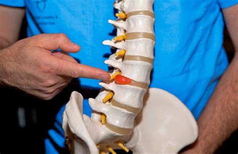 მალთაშუა დისკების თიაქარი ოპერაციის გარეშე განკურნებადია მსუბუქი ვარჯიშები და მარტივი რეცეპტი