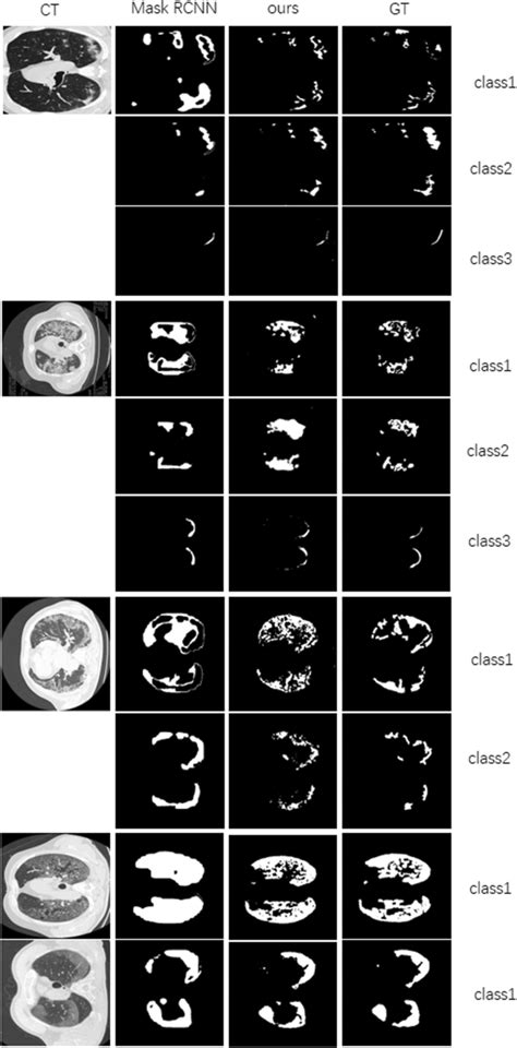 Visual Comparison Of Infection Segmentation In Detail Columns 14 Ct