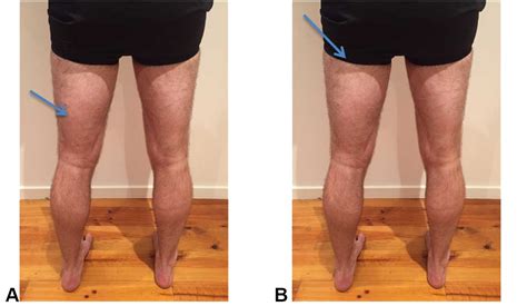 Hamstring Injury Management And Prevention South Coast Physiotherapy