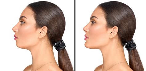 Chirurgie esthétique istanbul turquie