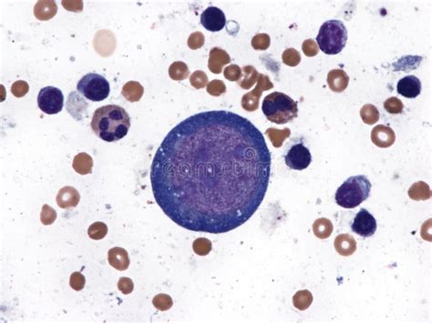 Infección Por Parvovirus Médula ósea Imagen de archivo Imagen de
