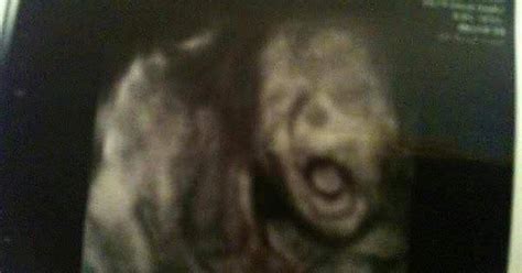 Ultrasound Album On Imgur