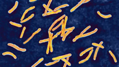 Un Test De Détection Rapide De La Tuberculose Mis Au Point