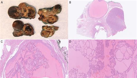 Main Histological Attributes Of Ki 1 Case A Thyroid Follicular Nodular Download Scientific