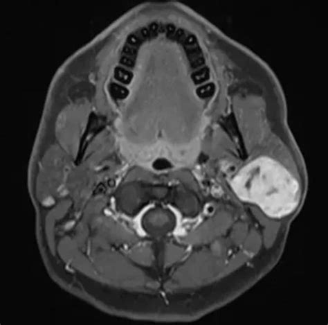 Parotid Glands Mri Mri Is Preferred Over Ct For Characterizing