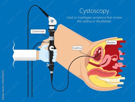 Cystoscopy Diagnose Bladder Diseases And Conditions Exam Treat Benign