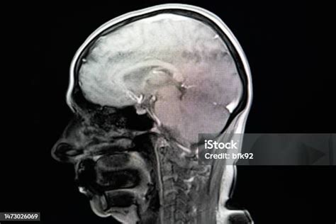 뇌 Mri 스캔 뇌의 자기 공명 이미지 스캔 진단 의료 도구 스캐닝에 대한 스톡 사진 및 기타 이미지 스캐닝 의료용 스캐너