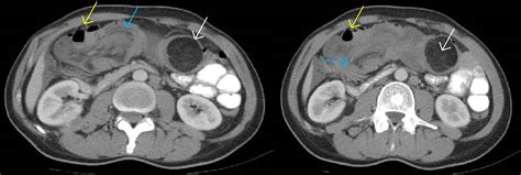 Transverse Colon Submucosal Lipoma Presenting With Colocolic Acg