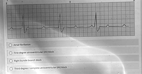 Solved Atrial Fibrillation First Degree Atrioventricular Av Block