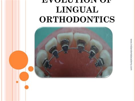 Evolution Of Lingual Orthodontics Ppt