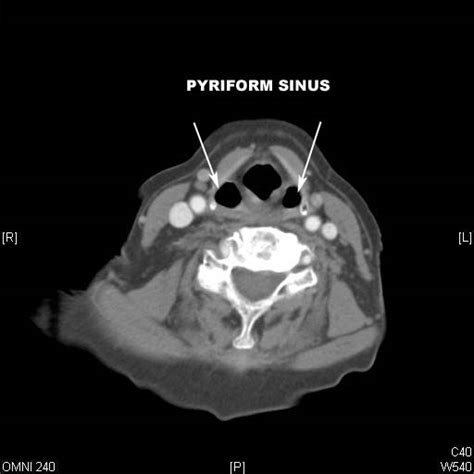 Pyriform Sinus