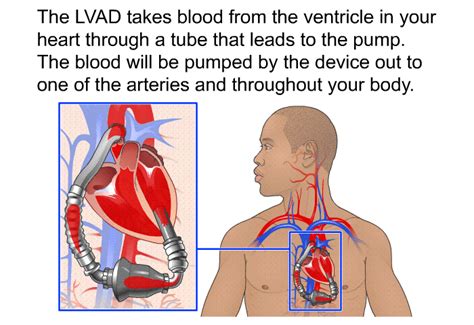 Lvad Left Ventricular Assist Device