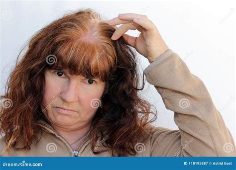 A Woman Has Problems With Hair Loss And A Sensitive Scalp Stock Image Image Of Help Hair