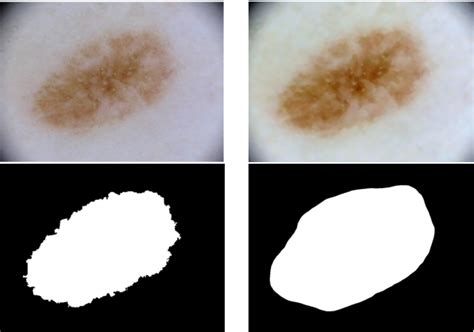 Figure 4 From Deep Learning And Transfer Learning For Skin Cancer Segmentation And