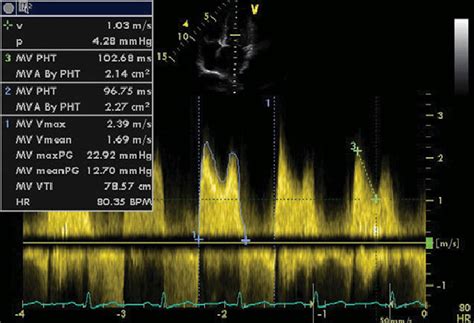 Continuos Wave Doppler Analysis Of Mitral Inflow Showing Moderate Download Scientific Diagram