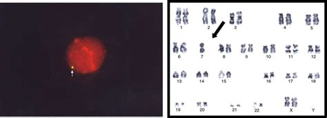 Monosomy 7