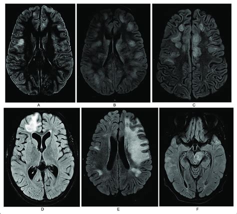 A Initial Mri Showing Bilateral T2 Flair Hyperintensities Throughout