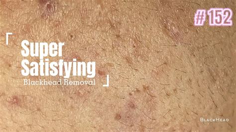Super Satisfying Blackhead Removal Youtube