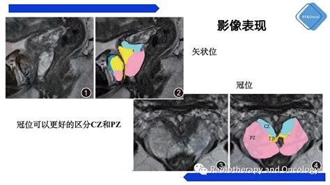 前列腺的解剖及mr表现