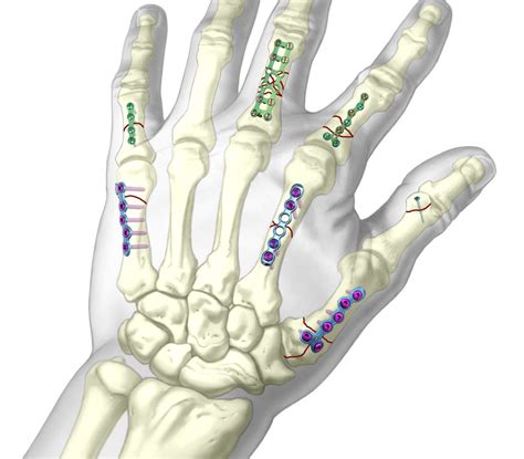 Hand Plates Phalangeal And Metacarpal Fracture Treatment Trimed Inc
