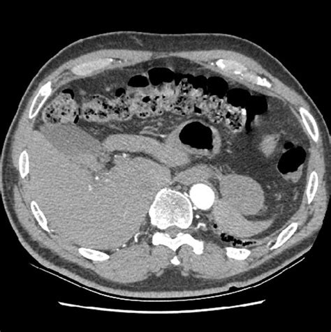 Automated Technique To Measure Noise In Clinical Ct Examinations Ajr