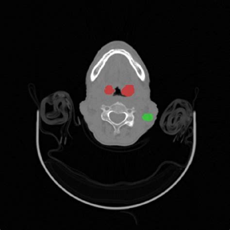 An Example Of Ct Image Showing Sagital Coronal And Axial Slices With