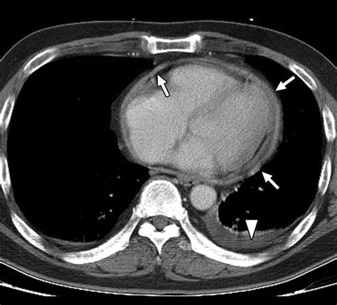 Chest X Ray Findings In Pericardial Effusion At Danica Jones Blog