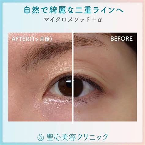聖心美容クリニック公式アカウント さんのインスタグラム動画 聖心美容クリニック公式アカウント Instagram「 自然で綺麗な二