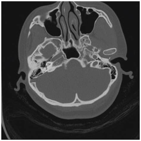 A Case Of Vascular Pulsatile Tinnitus In The Left Ear Occurred 4 Years