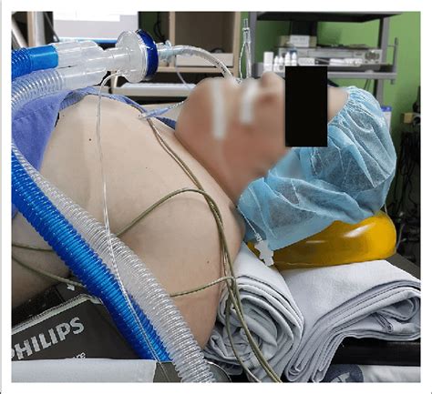 A Morbidly Obese Patient With Prader Willi Syndrome Download