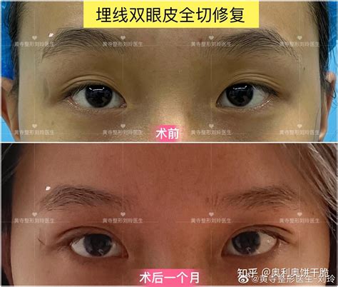 国内北京双眼皮修复医生哪个好？金鑫、黄寺刘玲、刘学源、八大处王太玲、韩新鸣、协和朱琳、韩勋 知乎