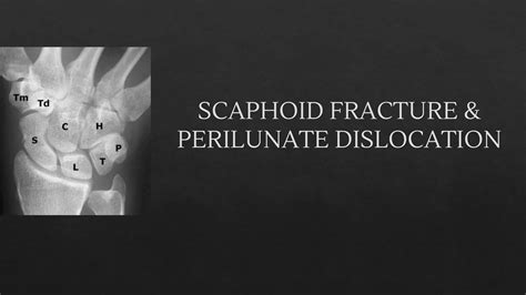 Scaphoid Fracture And Perilunate Dislocation Ppt