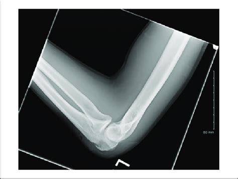 Left Elbow X Ray On Admission Download Scientific Diagram