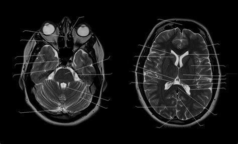 Diagram Of Brain Mri Axial Views Quizlet