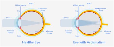 Astigmatism Causes Types Symptoms And Treatment Smartbuyglasses Uk