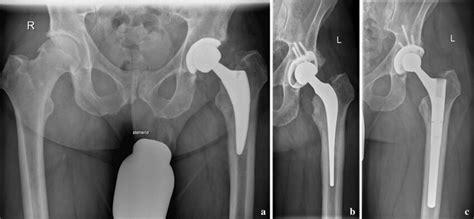 Endofemoral Approach In Case Of A Loosened Cementless Stem A Infected