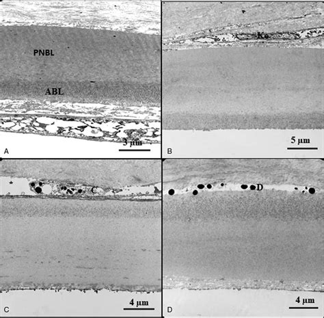 Transmission Electron Micrographs Of Explanted Corneal Buttons After