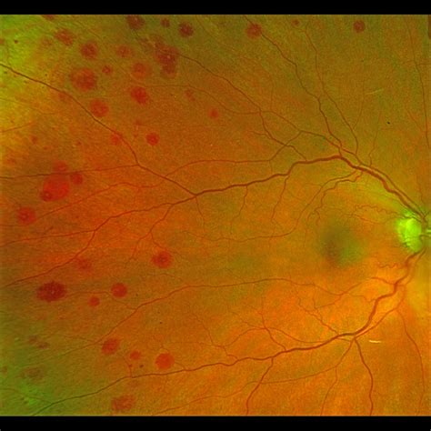 Dr Alan N Glazier On Linkedin Retinarocks Deep Retinal Hemorrhages