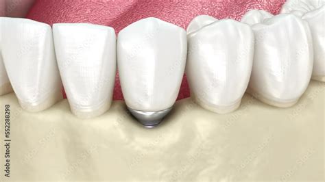 Peri Implantitis And Gingiva Recession Dental 3d Animation Vídeo De