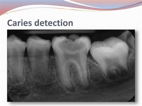 Parallel Angle Technique Vs Bisecting Angle Technique Pptx Dental