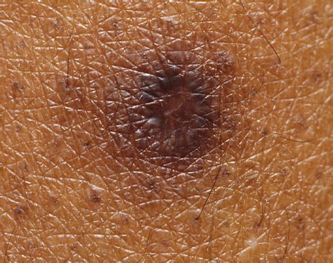 Photo Gallery Of Skin Conditions School Of Medicine