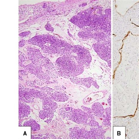 A Common To All Grades Of Olfactory Neuroblastoma Is The Lobular Growth Download Scientific